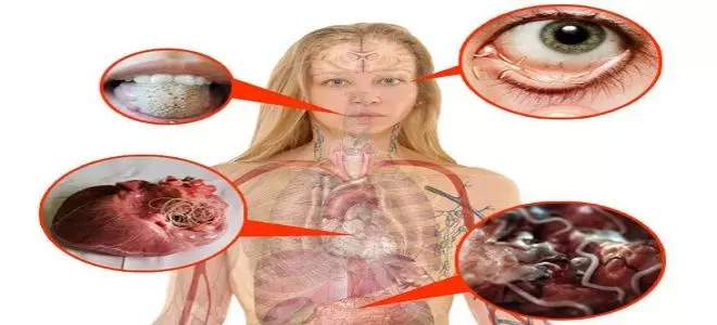 دستکش علائم در بزرگسالان است. عفونت بدن با انگل - دور، آستراسیوز، opistorhoz، trichinosis 10030_2