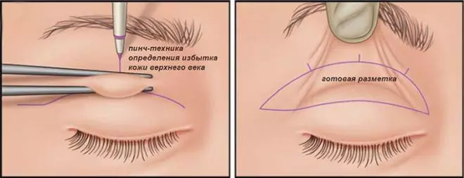 Gornji kapci, laserska blefaroplastika - prije i poslije, kontrarojavna. Što je transcontium blophplasty? 10048_4