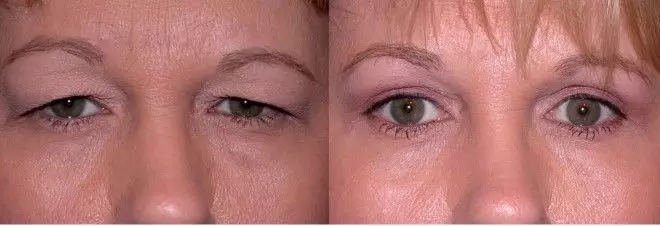 Øvre øjenlåg, laser blepharoplasty - før og efter, kontraheret. Hvad er Transcontium Blophoplasty? 10048_5