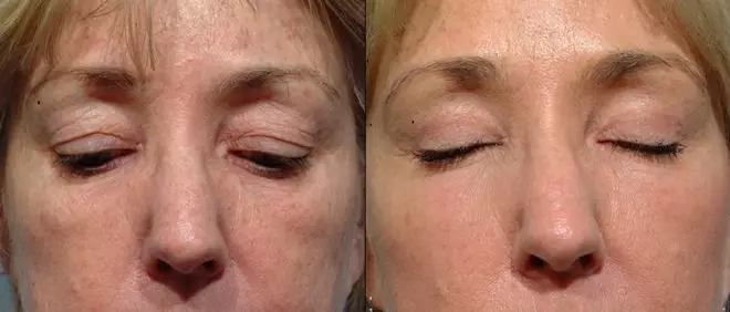 Övre ögonlock, laser blepharoplasty - före och efter, kontrama. Vad är Transcontium Blophoplasty? 10048_6