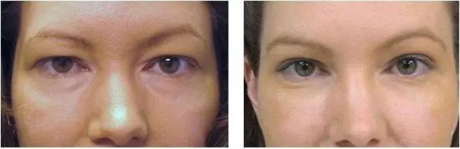 Øvre øjenlåg, laser blepharoplasty - før og efter, kontraheret. Hvad er Transcontium Blophoplasty? 10048_7