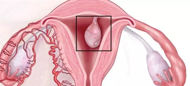 Polip uterus - tedavi için endometrial. Uterus'ta bir polipin çıkarılması - Polip nasıl çıkarılır? 10170_2