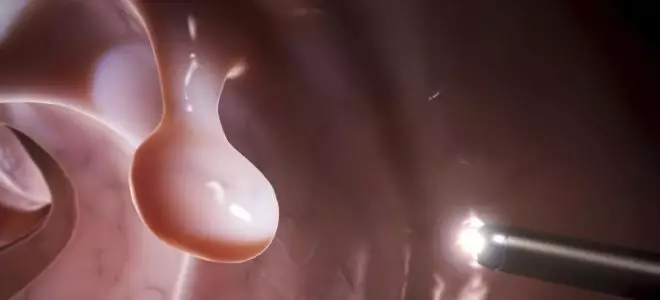 Polip uterus - tedavi için endometrial. Uterus'ta bir polipin çıkarılması - Polip nasıl çıkarılır? 10170_5