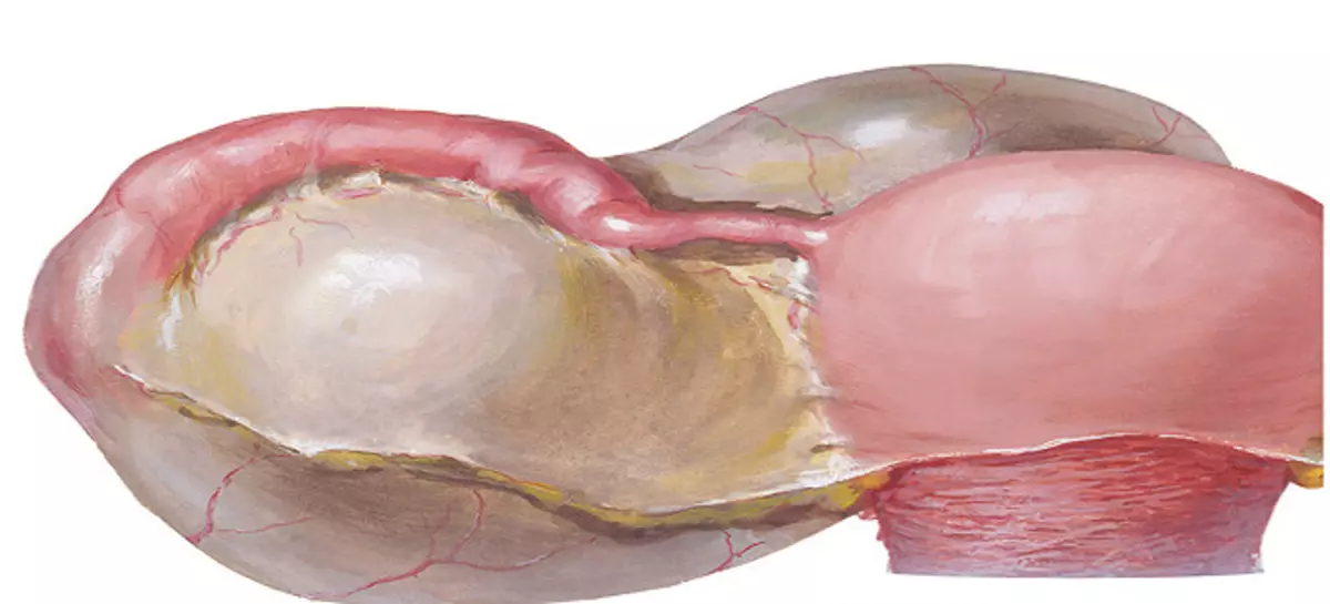 Hydrosalpinx (floeistof yn 'e uterine buis) - behanneling sûnder operaasje, operaasje. Hydrosalpinx op ultrasound 10173_2