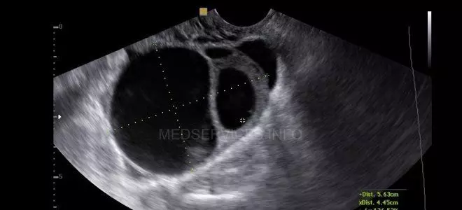 Hydrosalpinx (Flësseg an der Gebärmutterzuch) - Behandlung ouni Operatioun, Operatioun. Hydrosalpinx op Ultraschall 10173_3