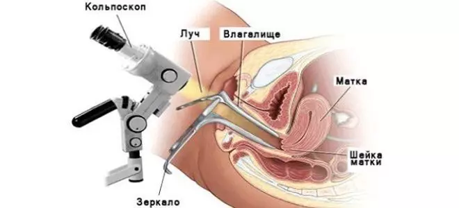 Колпоскопи - Энэ процедур нь Gynecology-д ямар процедур гэж юу вэ? Колпозкопи хийх бэлтгэл 10263_2