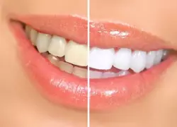 Tasiri hakora whitening