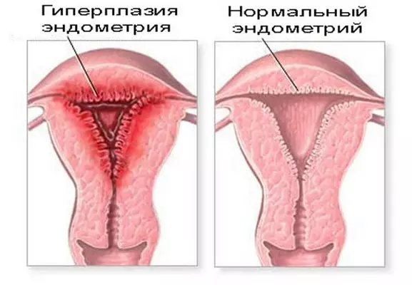 Az endometrium patológia