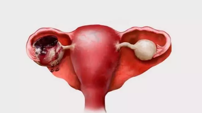 Follicular cyst ovarian