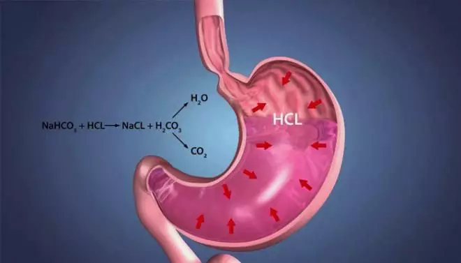 Gastroezofageální refluxní onemocnění