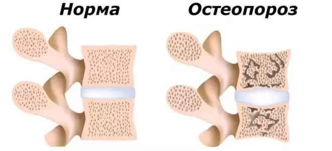 Osteoporosis - matšoao a basali, matšoao a masapo a masapo, ho sekaseka ha osteoporosis 22840_3