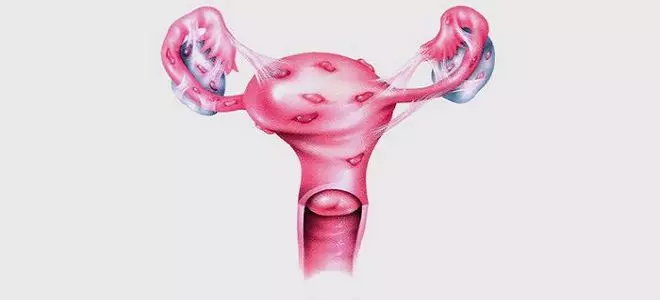 Endometriose van die baarmoeder - wat is dit beskikbaar taal? Endometriose van die nek, die liggame van die baarmoeder - simptome en behandeling 23179_2