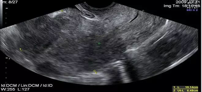 Endometriose van die baarmoeder - wat is dit beskikbaar taal? Endometriose van die nek, die liggame van die baarmoeder - simptome en behandeling 23179_3