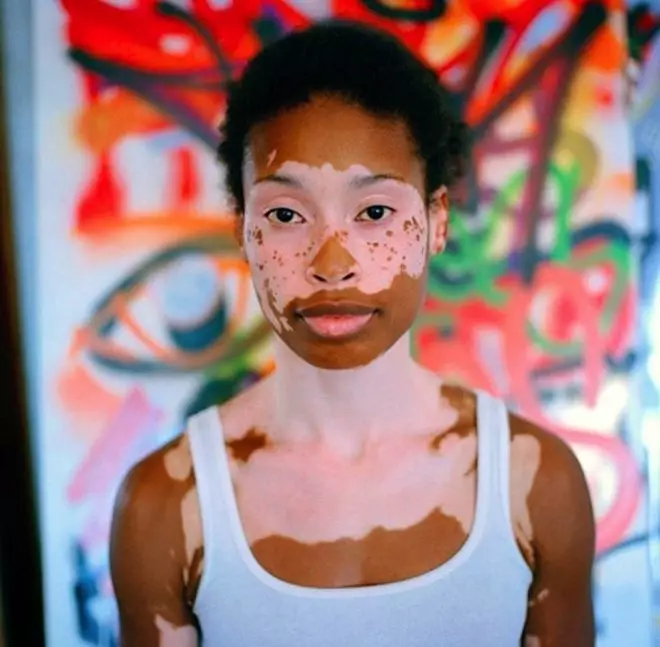 გოგონა Vitiligo