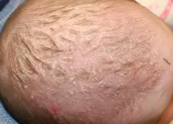 Seborrheic dermatitis-ka ee dhallaanka