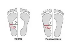 Jenis flatfoot pada anak-anak