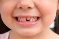 Çfarë dhëmbësh bien tek fëmijët