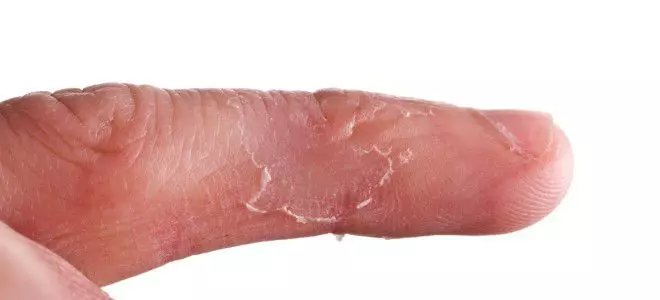 त्वचा रोग, मनुष्यांमध्ये त्वचा रोग - प्रजाती, निदान, उपचार 31135_24