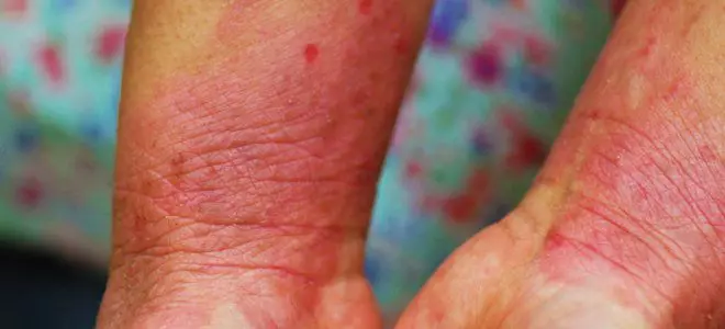 त्वचा रोग, मनुष्यांमध्ये त्वचा रोग - प्रजाती, निदान, उपचार 31135_26