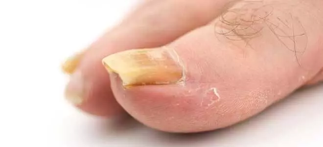 Psoriasis síntomas de uñas.