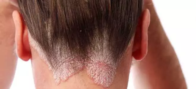 Síntomas da cabeza de psoriasis