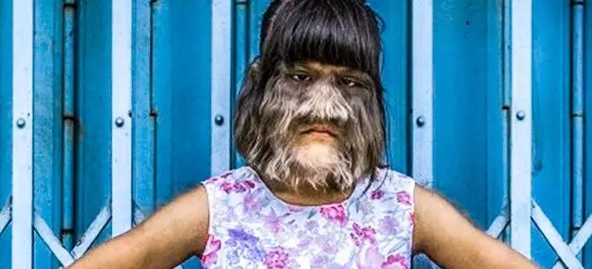 Hypertrichosis mewn menywod, dynion - beth yw hwn (llun)? 32524_4