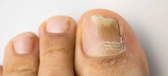 Behandling av nagelsvamp på ben, hender (lansert form) 33212_2