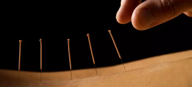 Keuntungan akupunktur lan gawe piala
