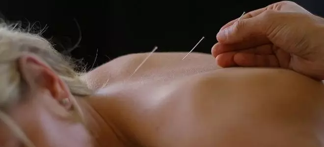 I-Acupuncture kunye nenzakaliseko2
