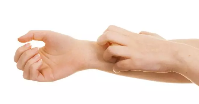 एक्झामा हात - कारणे, लक्षणे आणि रोग प्रभावी उपचार