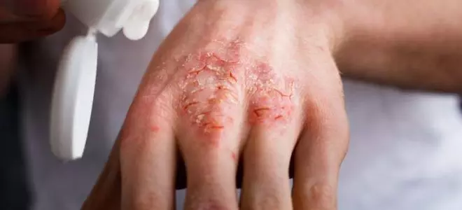 Eczema ในมือ - วิธีการรักษา? แท็บเล็ต, ครีม, การเยียวยาพื้นบ้านจากกลาก 33577_2