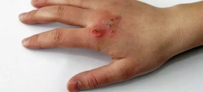 Eczema ในมือ - วิธีการรักษา? แท็บเล็ต, ครีม, การเยียวยาพื้นบ้านจากกลาก 33577_3