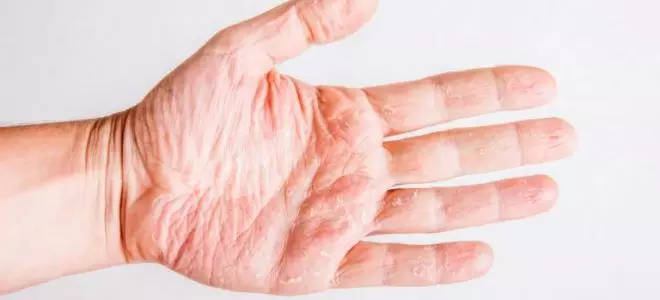 Eczema ในมือ - วิธีการรักษา? แท็บเล็ต, ครีม, การเยียวยาพื้นบ้านจากกลาก 33577_4