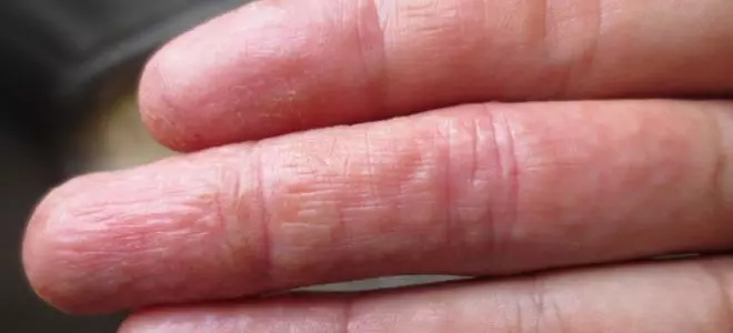 Eczema ในมือ - วิธีการรักษา? แท็บเล็ต, ครีม, การเยียวยาพื้นบ้านจากกลาก 33577_5