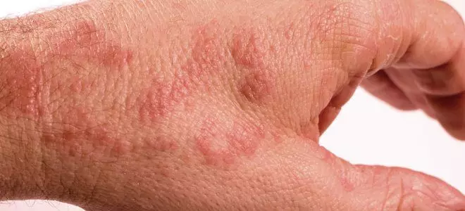 Eczema ในมือ - วิธีการรักษา? แท็บเล็ต, ครีม, การเยียวยาพื้นบ้านจากกลาก 33577_6