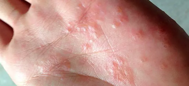 Eczema ในมือ - วิธีการรักษา? แท็บเล็ต, ครีม, การเยียวยาพื้นบ้านจากกลาก 33577_7