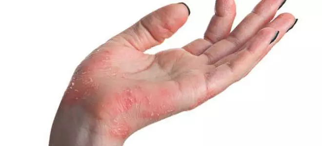 Eczema ในมือ - วิธีการรักษา? แท็บเล็ต, ครีม, การเยียวยาพื้นบ้านจากกลาก 33577_8