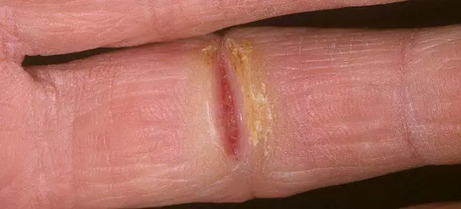 Eczema ในมือ - วิธีการรักษา? แท็บเล็ต, ครีม, การเยียวยาพื้นบ้านจากกลาก 33577_9