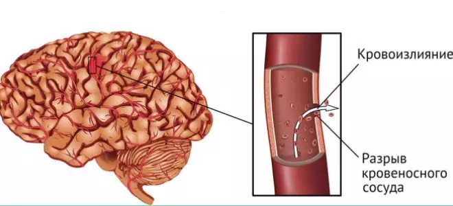 I-Homorrhagic ingqondo i-stroke (i-hemorrhage yengqondo) - Iimpawu, unyango, iziphumo 33683_2