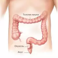 Adenokarcinom Colon-varselet