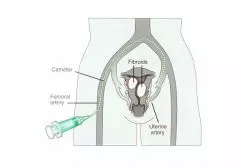 Embolization ຂອງເຮືອມົດລູກ