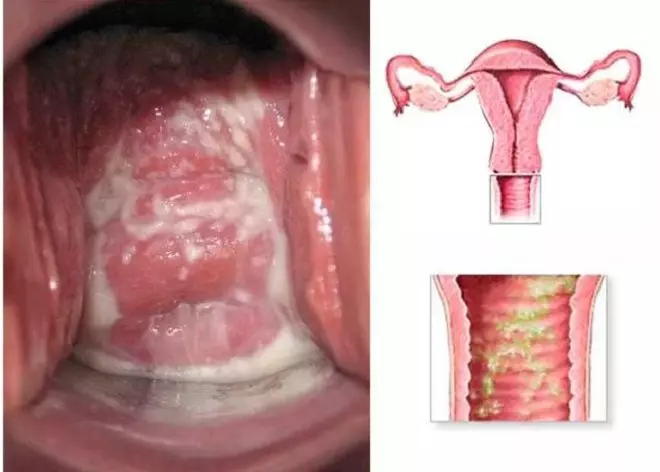 Голпит - хатын-кызлар өчен нәрсә ул? Trichomonade, candidomic, atrophic, colpit - симптом һәм дәвалау 34053_2