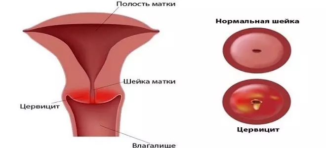 Cervicitis crònica (inflamació cervical) - Símptomes, tractament, preparats 34054_2