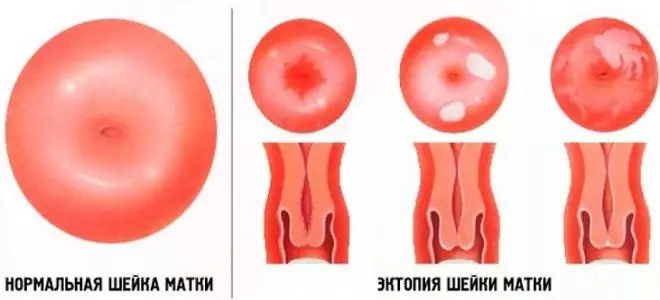 Kronisk cervicit (cervikal inflammation) - Symptom, behandling, preparat 34054_4