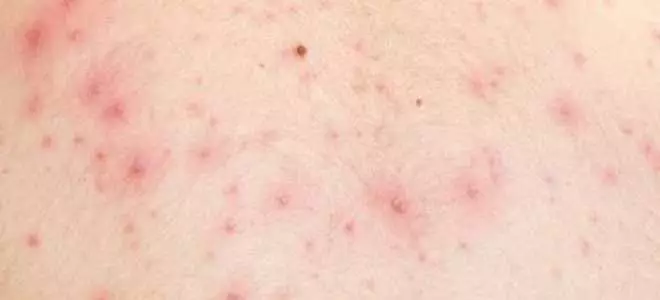 Candidiasis bij vrouwen - symptomen en behandeling, oorzaken van gebeurtenis. CANDIDA FUNGUS - Hoe de spruw bij vrouwen te behandelen? 34085_4