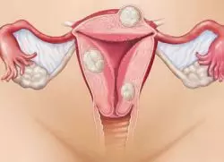 I-fibromatosis yomzimba we-uterus