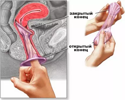 عورت جي ڪنڊوم 1 ڪئين ڪئين