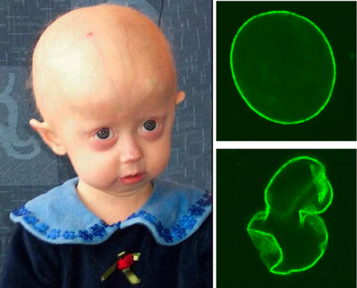 Hutchinson-Gilford Progeria Syndrome ရောဂါ