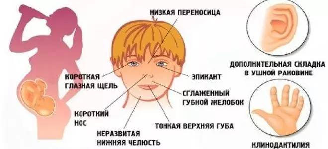 Alkohol Sindrom Janin - Mortalitas Perinatal 5170_2