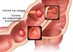Polyp rectum operazioa